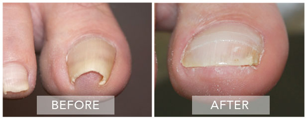 Nail Bracing - Doubleview Podiatry